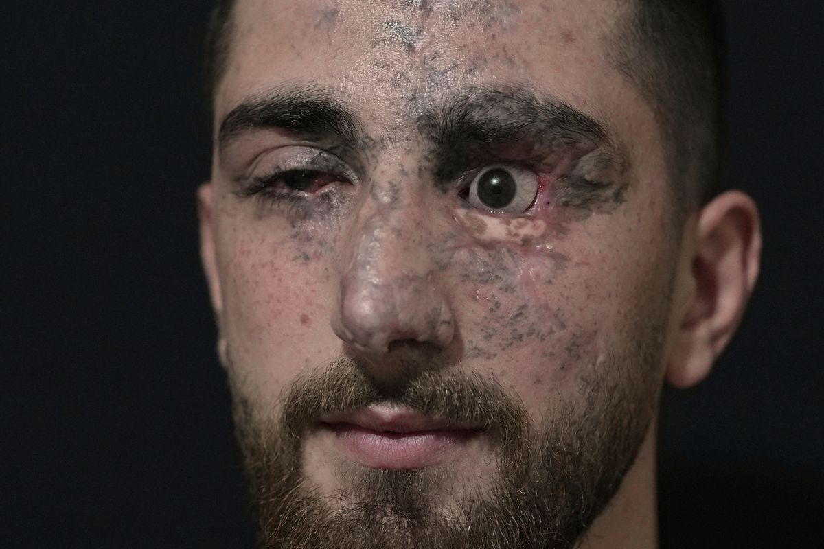 PHOTO ESSAY: Portraits of survivors of Israel's pager attack on Hezbol...